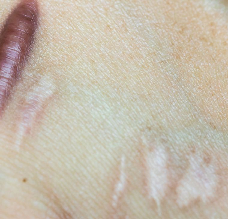 Cicatrizes Hipertróficas, Alargadas, Escavadas, Discrômicas – Clean Life